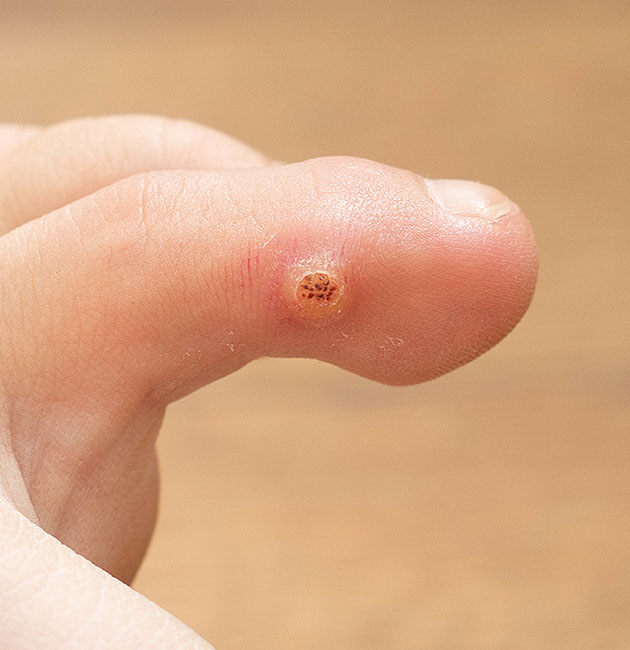 Plantar Warts Cairns Treatment - FNQ Podiatry & Orthotics - 4045 5749